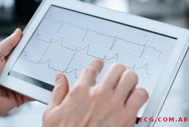 Electrocardiograma con Informe